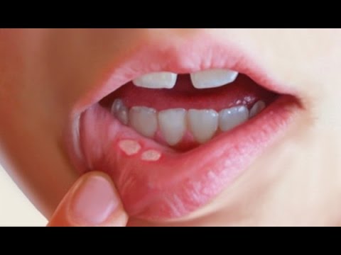 Rimedi afte: cause, rimedi naturali e farmaci - Salutarmente