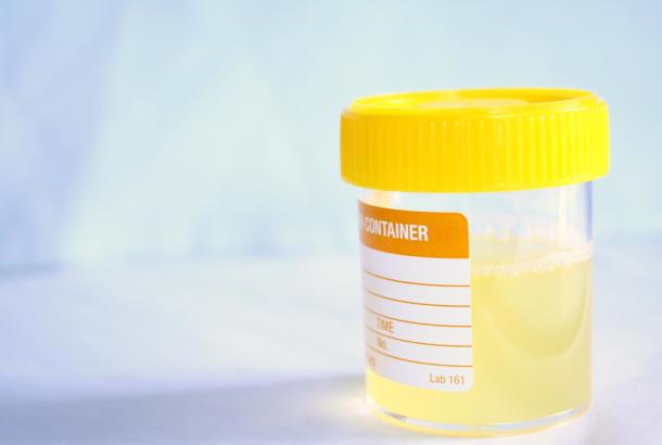 Urine Torbide: Scopri Tutte le Cause!