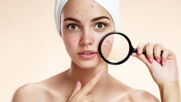 Pustole: Scopri Tutte le Possibili Cause ed i Rimedi!